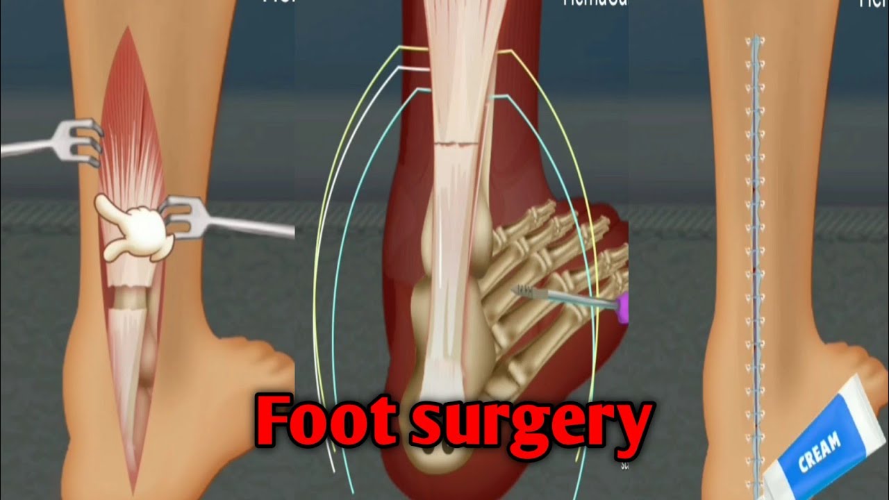 ASMR (Foot Tendon Repair) Foot surgery!! Foot - YouTube