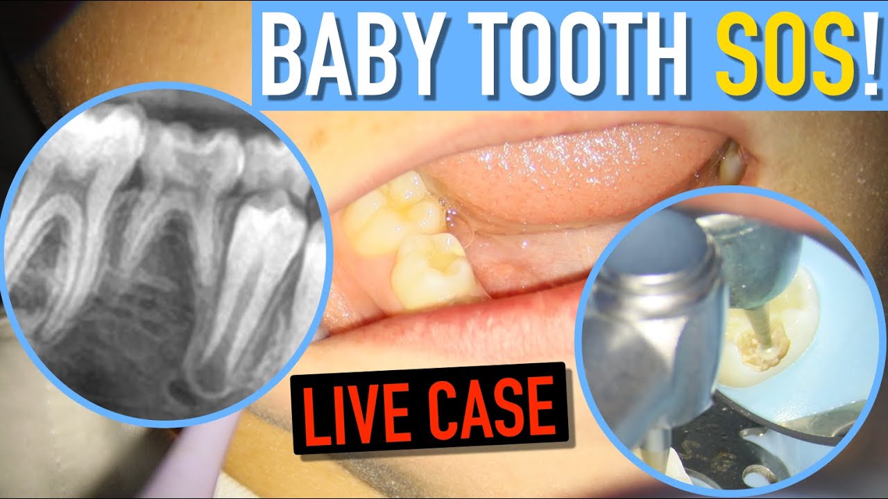 WHITE FILLING ON BABY TOOTH - HYPODONTIA | 4K Resolution - YouTube