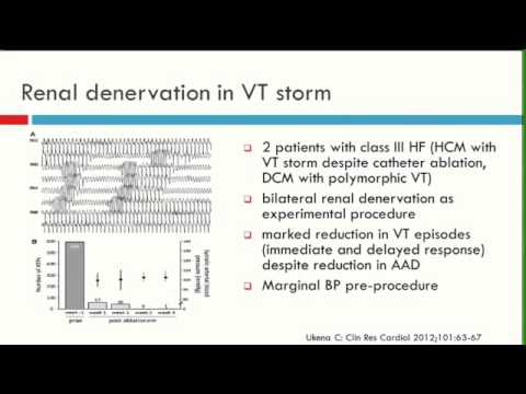 Comprehensive Management of Ventricular Tachycardia Storm - YouTube