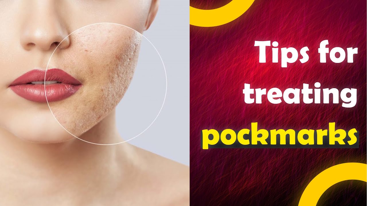 Skincare : The Best Treatment To Minimize Pockmarks 's appearance ...