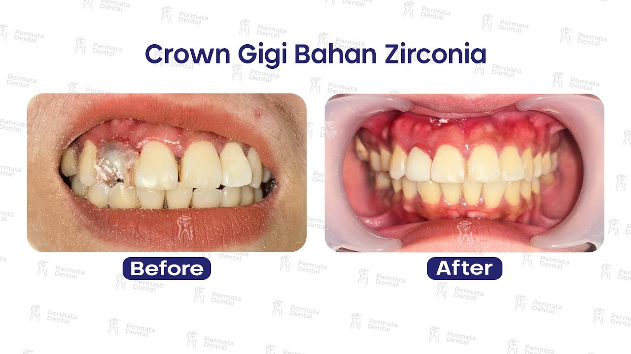 Proses Pembuatan & Pemasangan Gigi Crown Berbahan Zirconia di Permata ...
