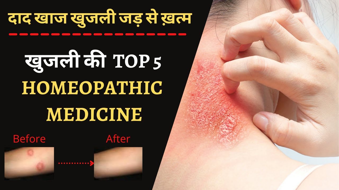 Ringworm homeopathic medicine | daad khaj khujli ka ilaj | fungal ...