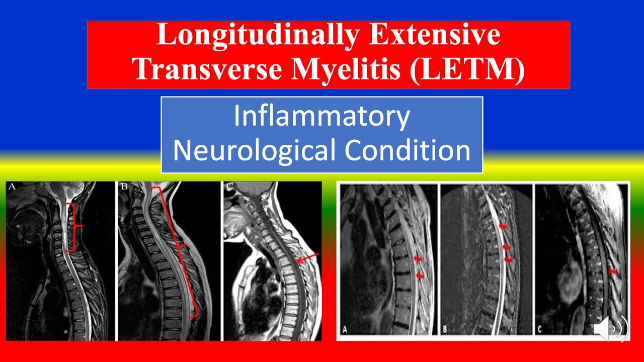 Longitudinally Extensive Transverse Myelitis (LETM) - Definition, types ...