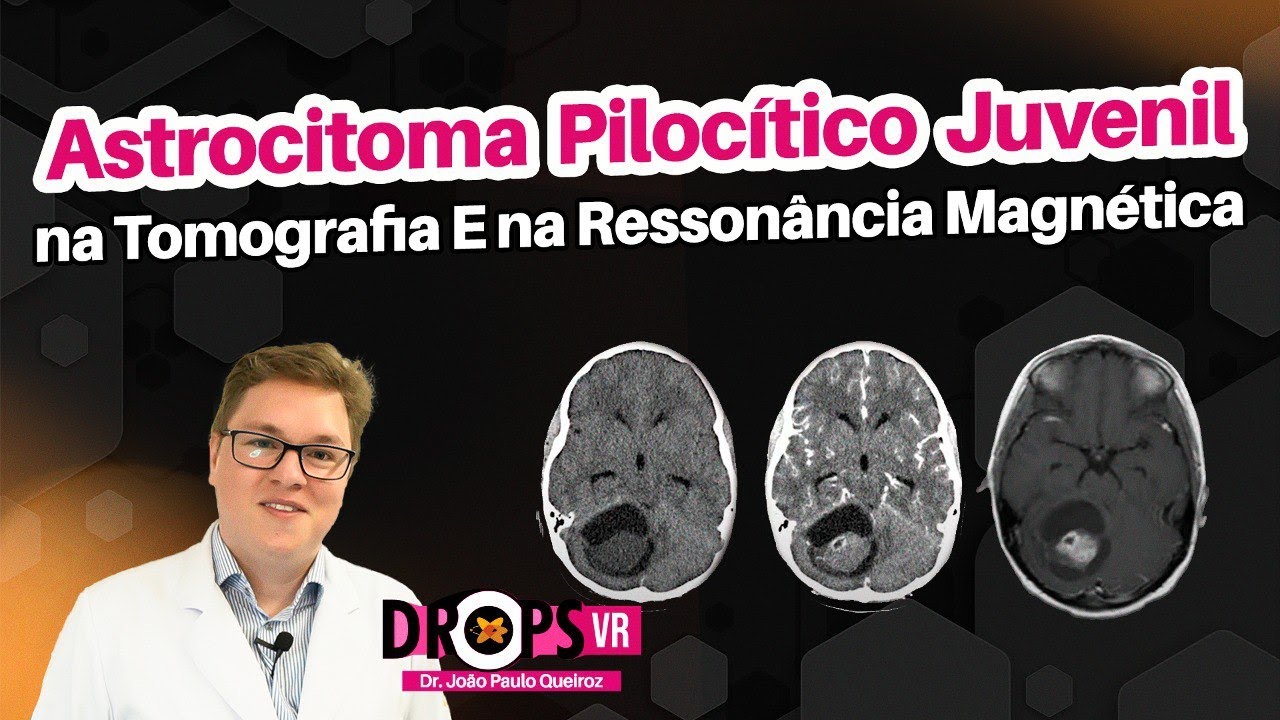 ASTROCITOMA PILOCÍTICO JUVENIL: COMO RECONHECER NA TC E RM? I VOCÊ ...