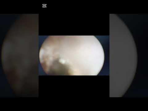 Right URS for difficult and severly impacted ureteric stone with sever ...