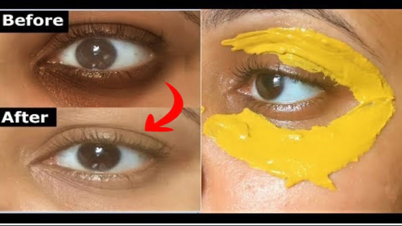 Dark circle Remove| how to get rid dark circles|how to remove dark ...