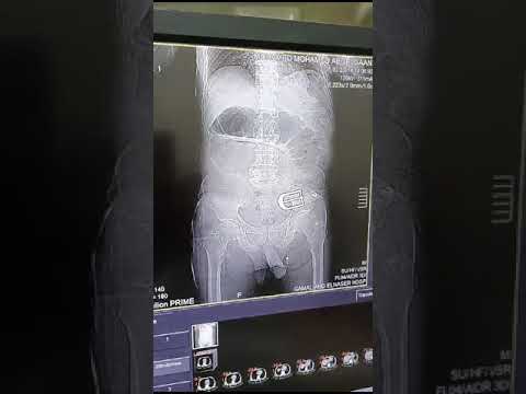 splenic flexure mass. - YouTube