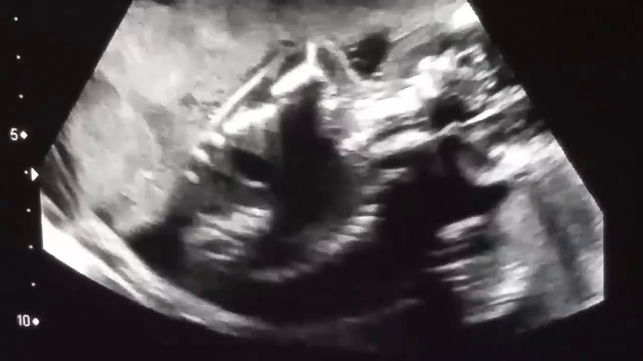 My baby at 7 and half months ultrasound - YouTube