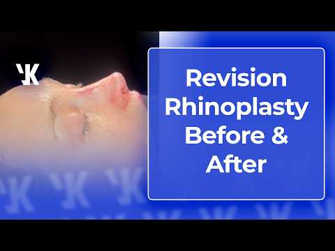 Revision Rhinoplasty Before & After | Op. Dr. Yunus Kaplan