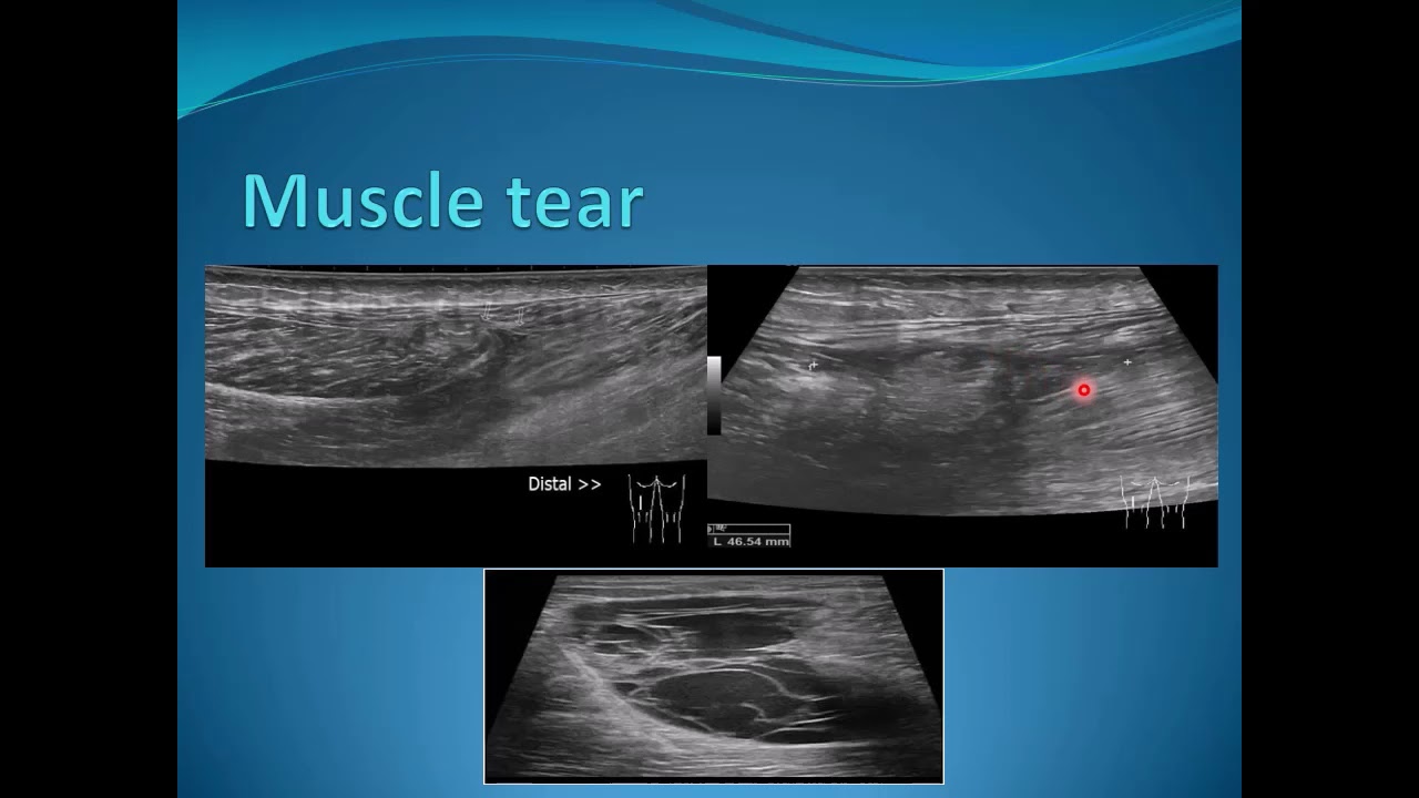 US hip and thigh pathology in adults(part2) - YouTube