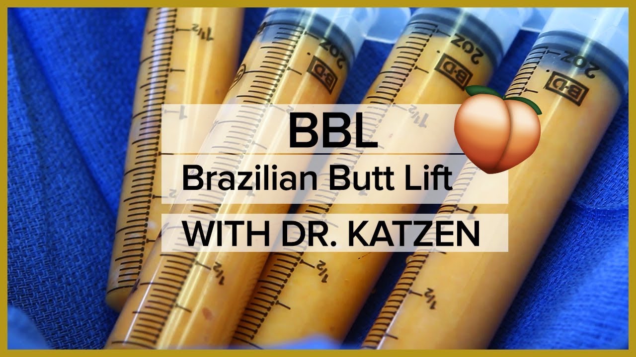 Brazilian Butt Lift Procedure - Transformation Tuesday with Dr. Katzen ...