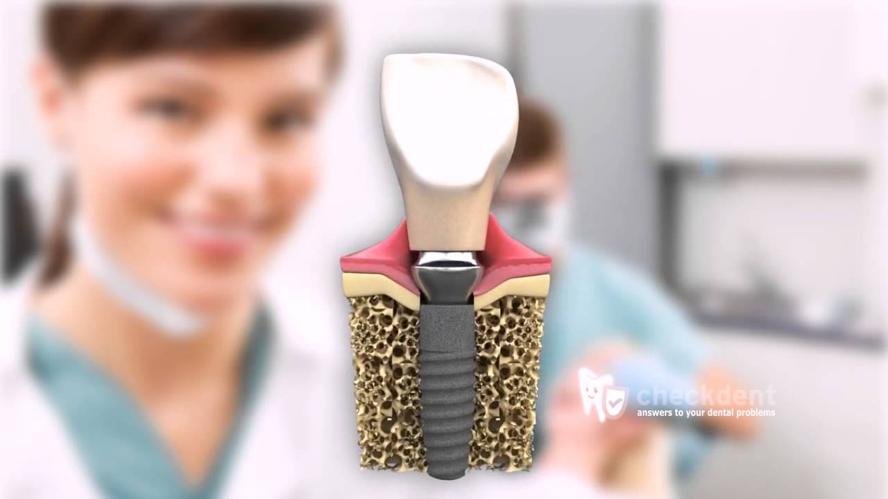 Conical Connection in dental Implantology - YouTube