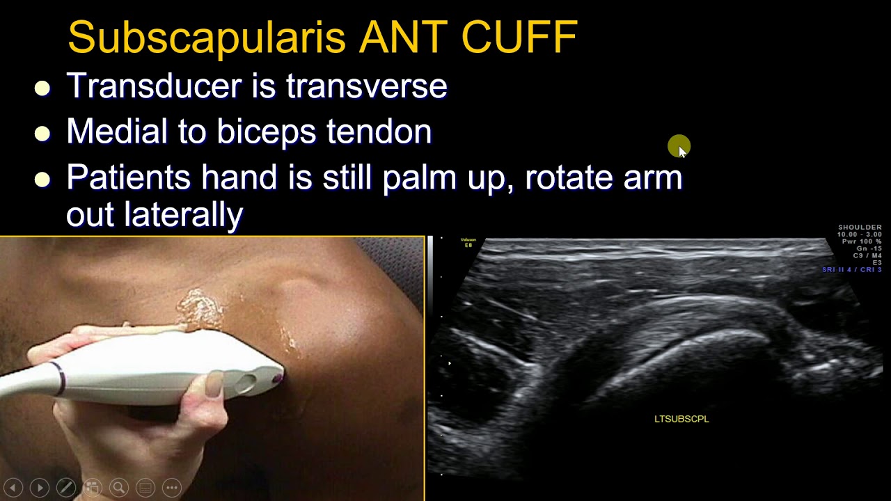 CAR 0002 USG OF ROTATOR CUFF - Dr. P. K. SRIVASTAVA - YouTube