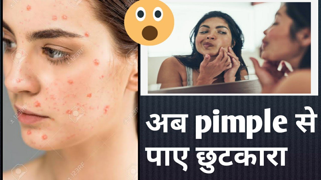 #How to remove pimples। how to remove acne।। #pimples remove naturally ...