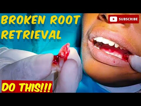 Epic Extraction Fail: #36 Root Retrieval using Cross-Bar Elevator # ...