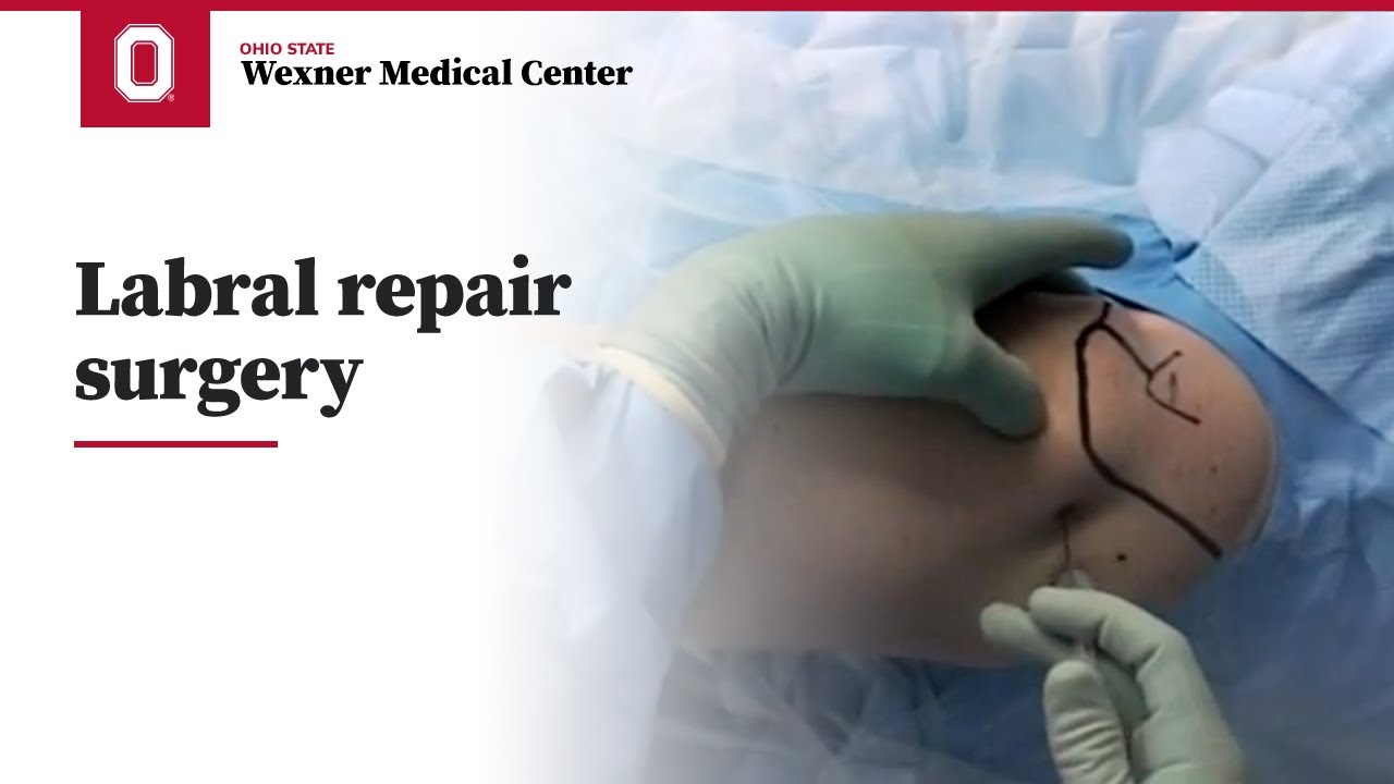 Labral repair surgery | Ohio State Medical Center - YouTube