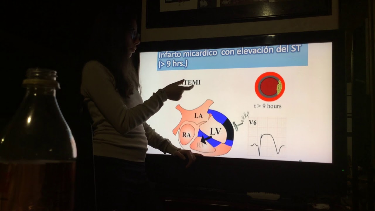 Onda Q patológica y T invertida. Infarto - YouTube