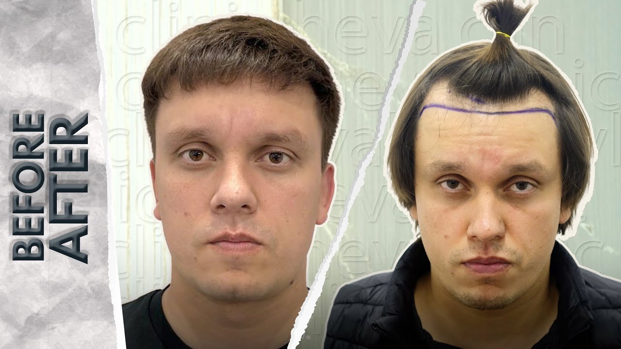 NO SHAVE HAIR TRANSPLANT RESULTS - 8 MONTHS TRANSFORMATION - Heva ...