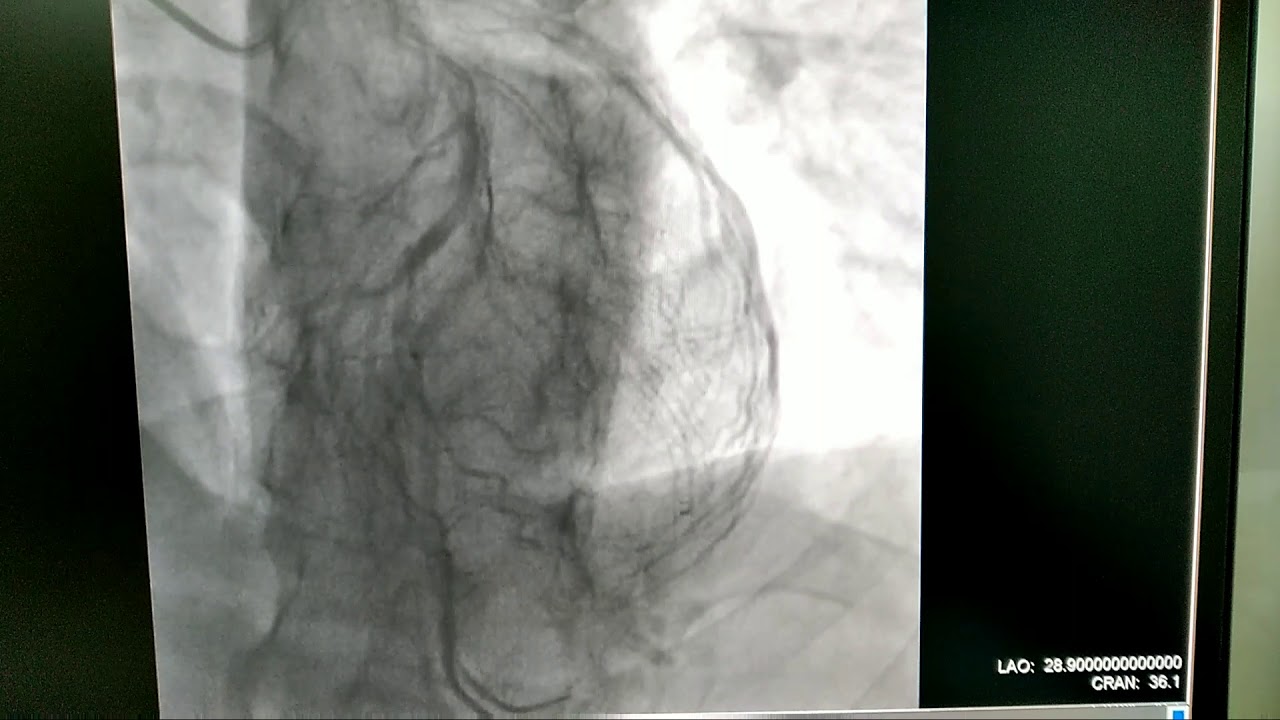 Slow flow in normal coronaries causing scary ECG - YouTube