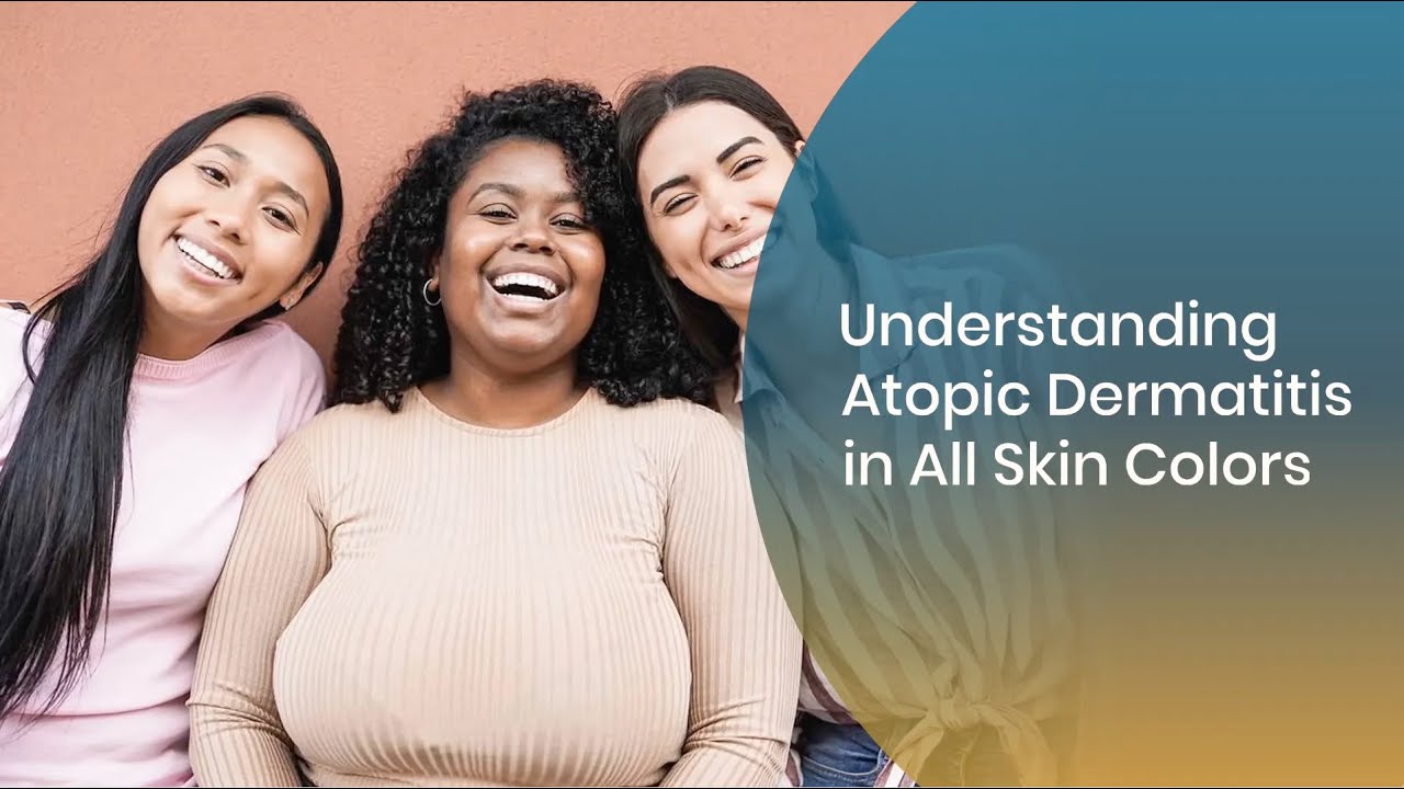 Understanding Atopic Dermatitis in Skin of Color - YouTube