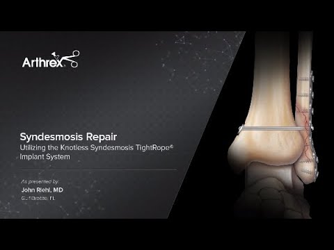 Syndesmosis Repair Utilizing the Knotless Syndesmosis TightRope ...