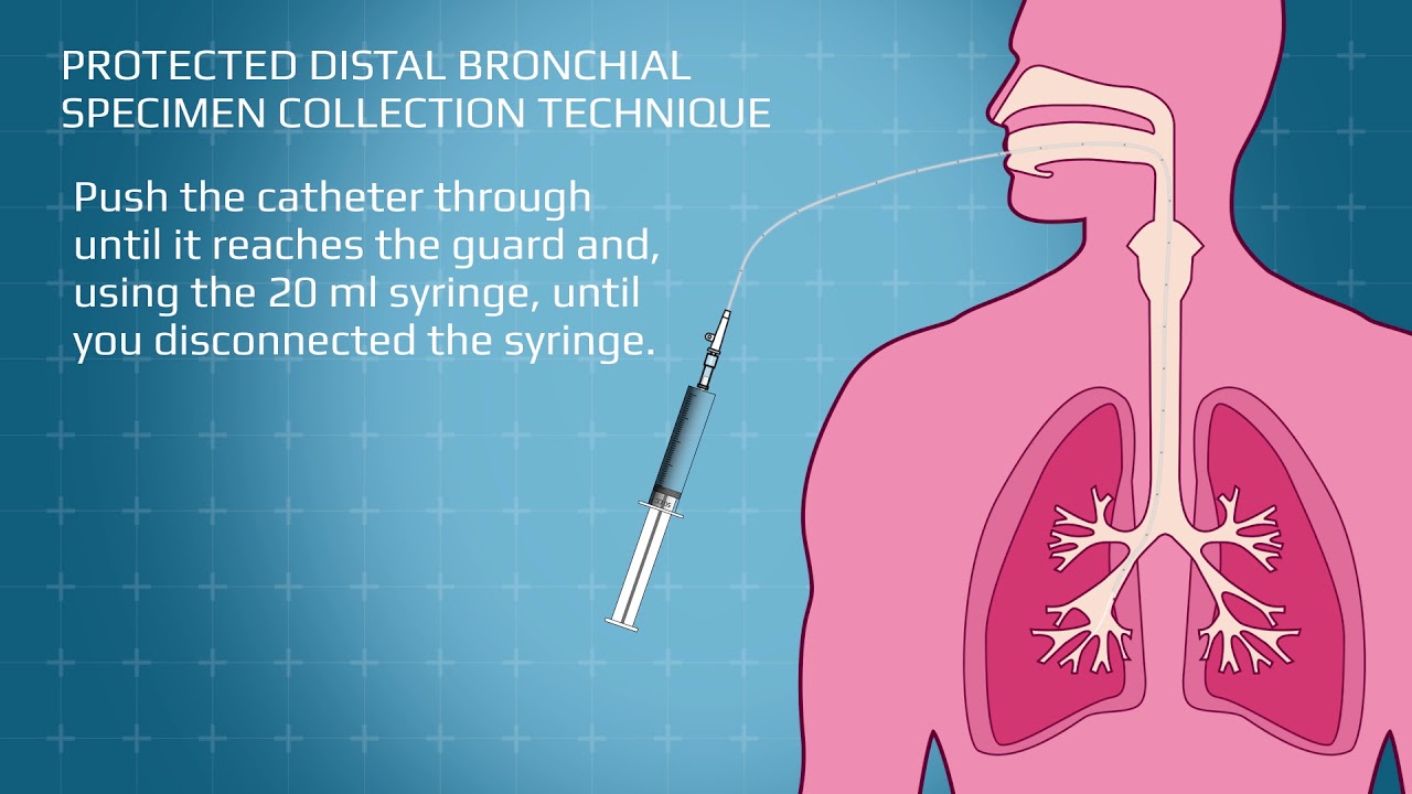 Aspiracion Bronquial COMBICATH - PULSAR MEDICAL - YouTube