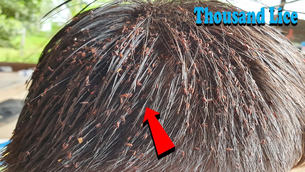 The best way to scratch these Giant lice from boy head - Lice comb ...