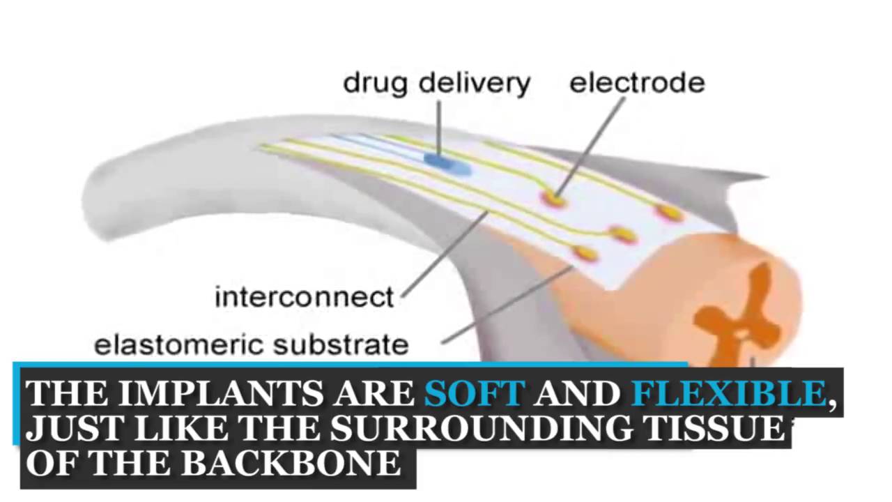 'Cyborg' spinal implant could help paralysed walk again - YouTube