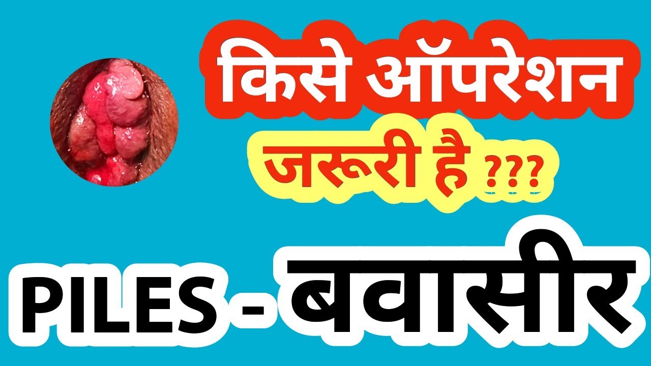 WHO NEEDS PILES OPERATION ? WHEN HEMORRHOIDS SURGERY ? कब बवासीर ऑपरेशन ...