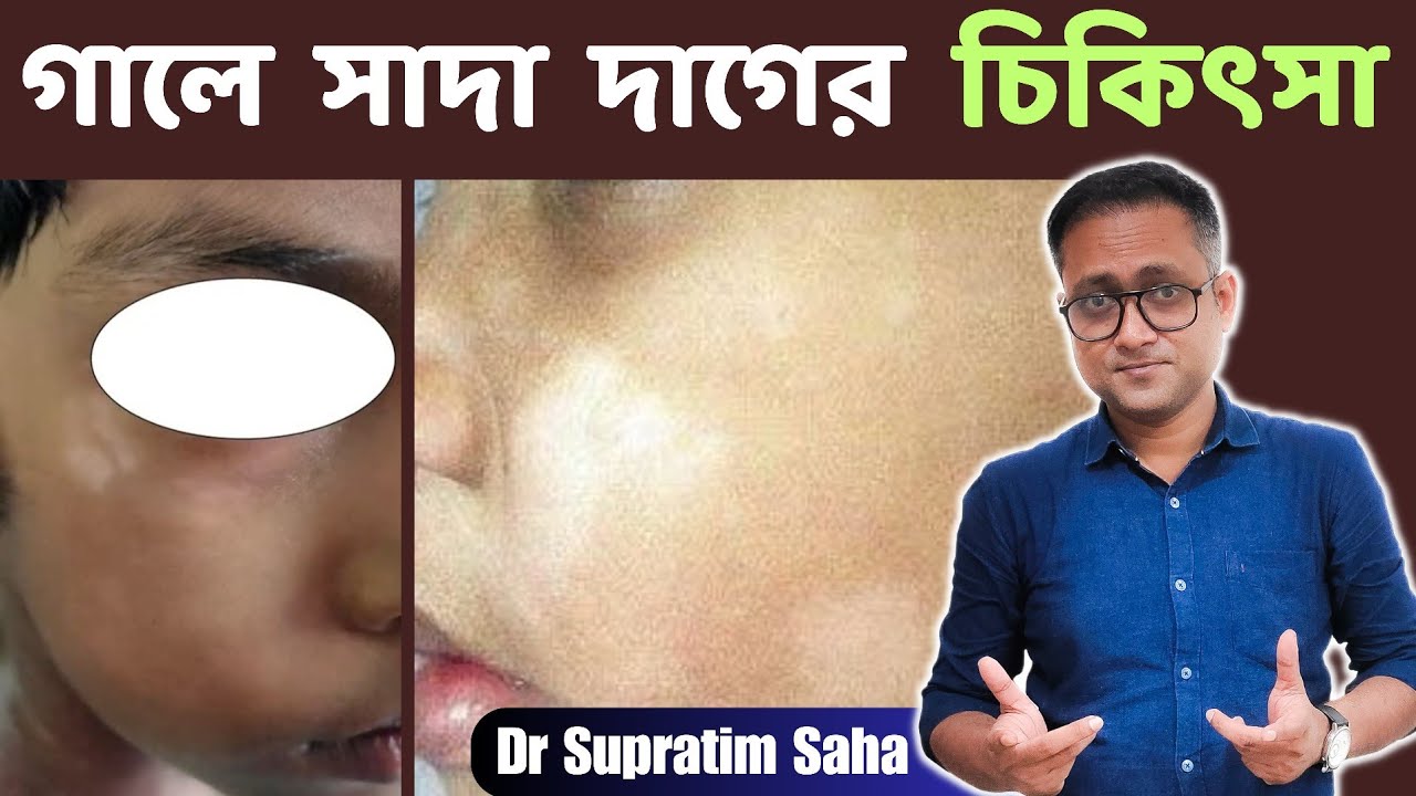 White spots on face | Pityriasis alba - YouTube