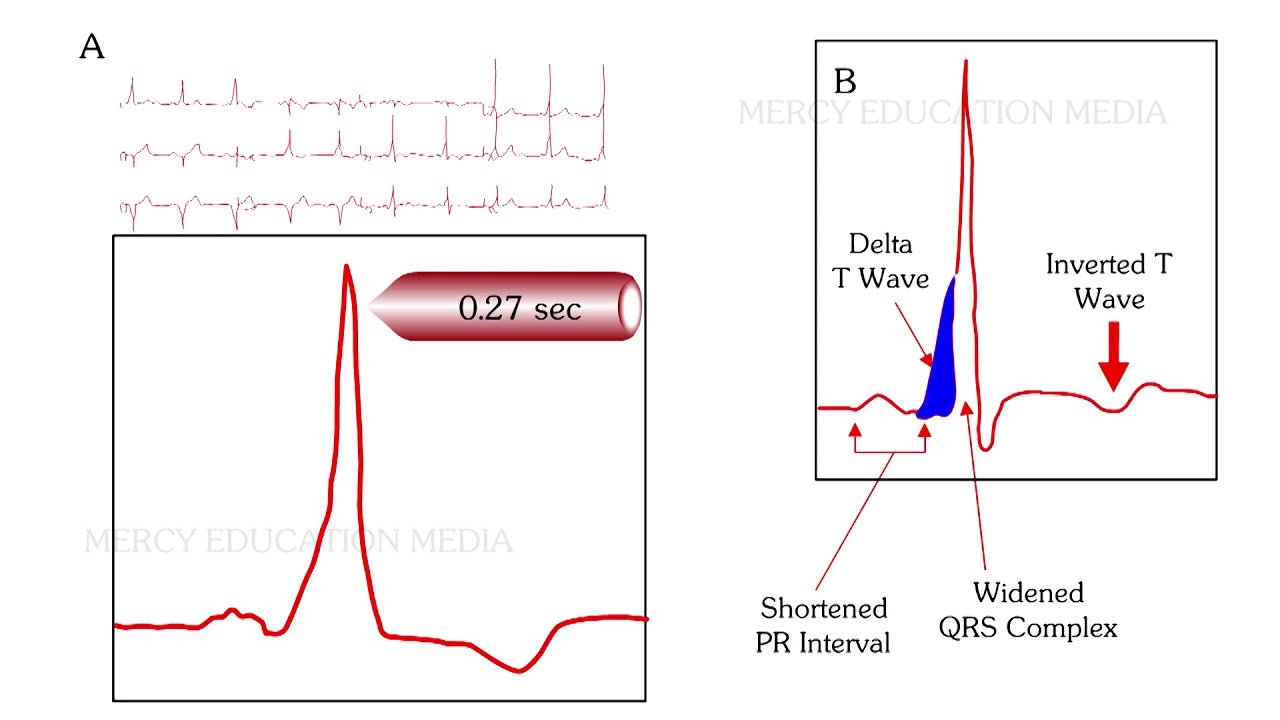 T WAVE IN ECG - YouTube