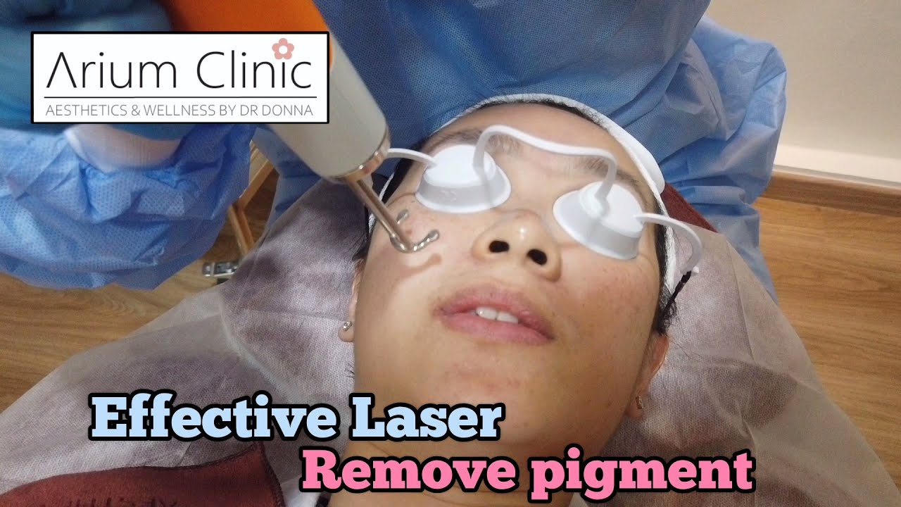 Effective Laser Remove Pigment - YouTube