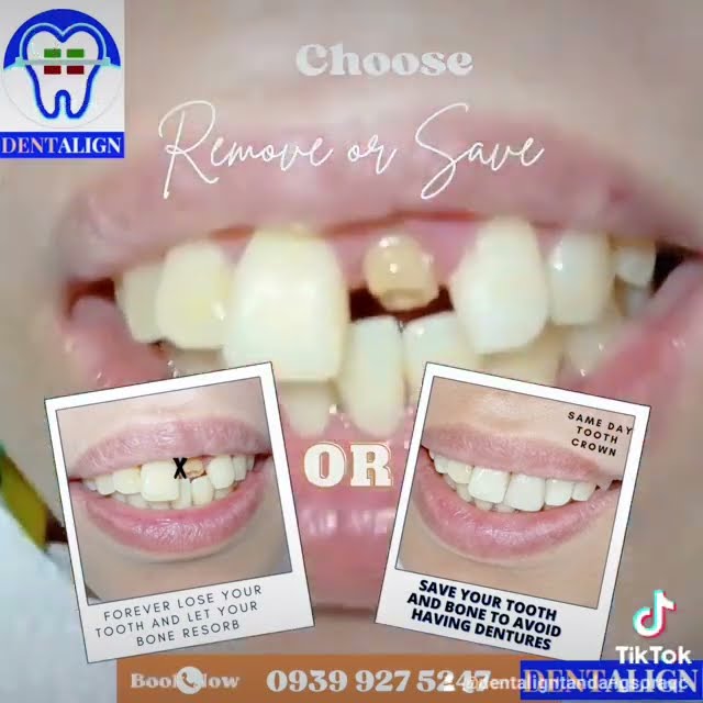 Voco Amaris Crown Build-up Done at Dentalign - YouTube