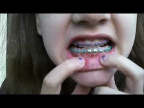A close up of my braces and molar brackets!! (With better lighting ...