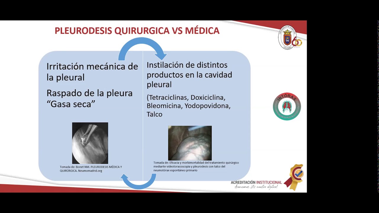 SEMINARIO:PLEURODESIS:BASES CONCEPTUALES,TÉCNICAS E INDICACIONES ...