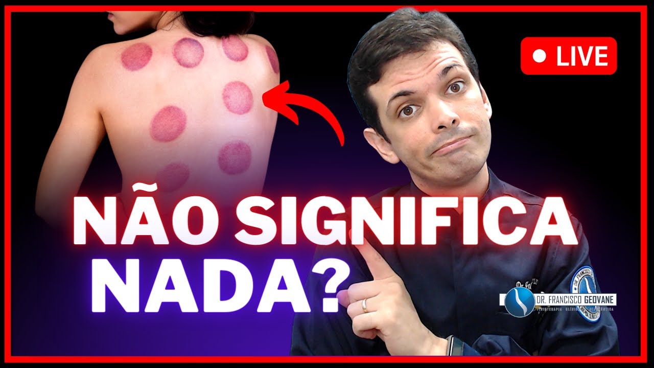 REAÇÕES À VENTOSATERAPIA - FICAR ROXO Não é NADA? (Como Assim?) - YouTube