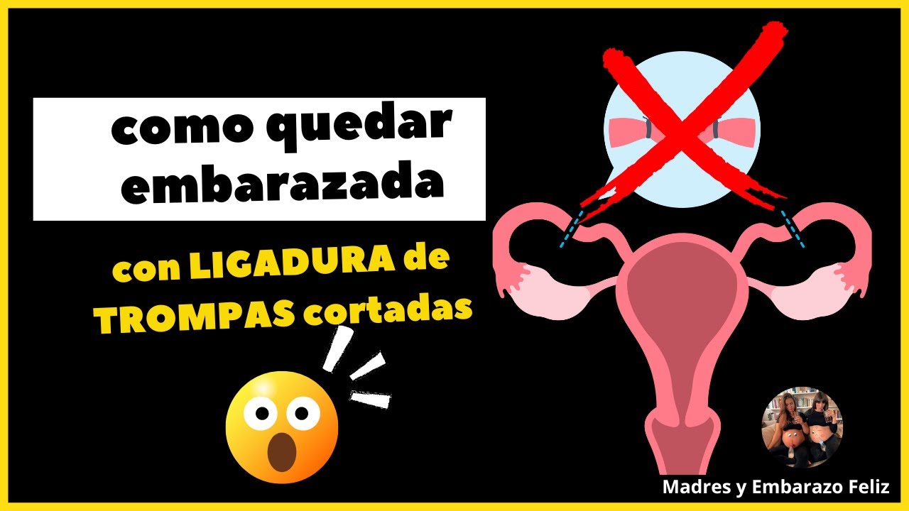 Como Quedar Embarazada con la Ligadura de Trompas #embarazo - YouTube
