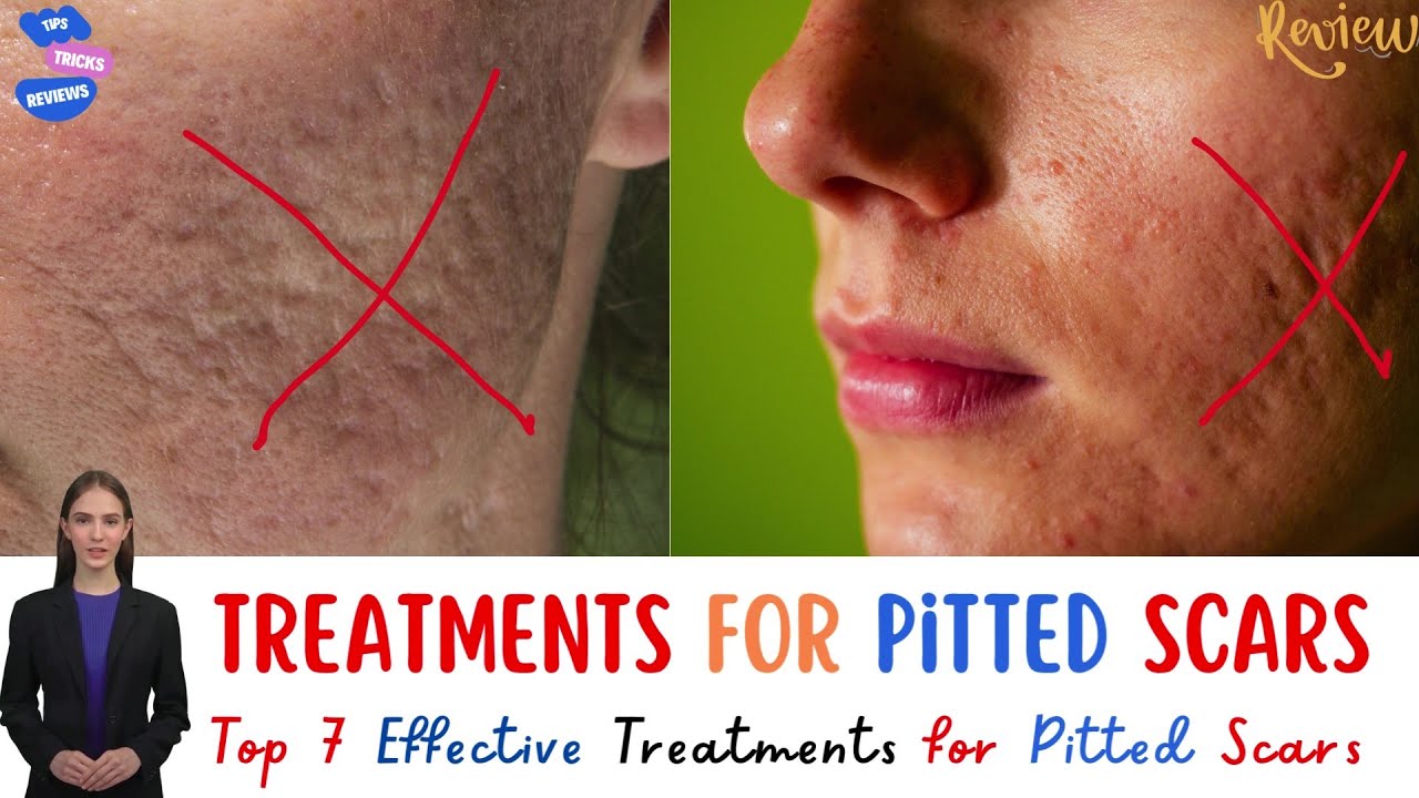 Top 7 Effective Treatments for Pitted Scars #skincare #skintreatment # ...