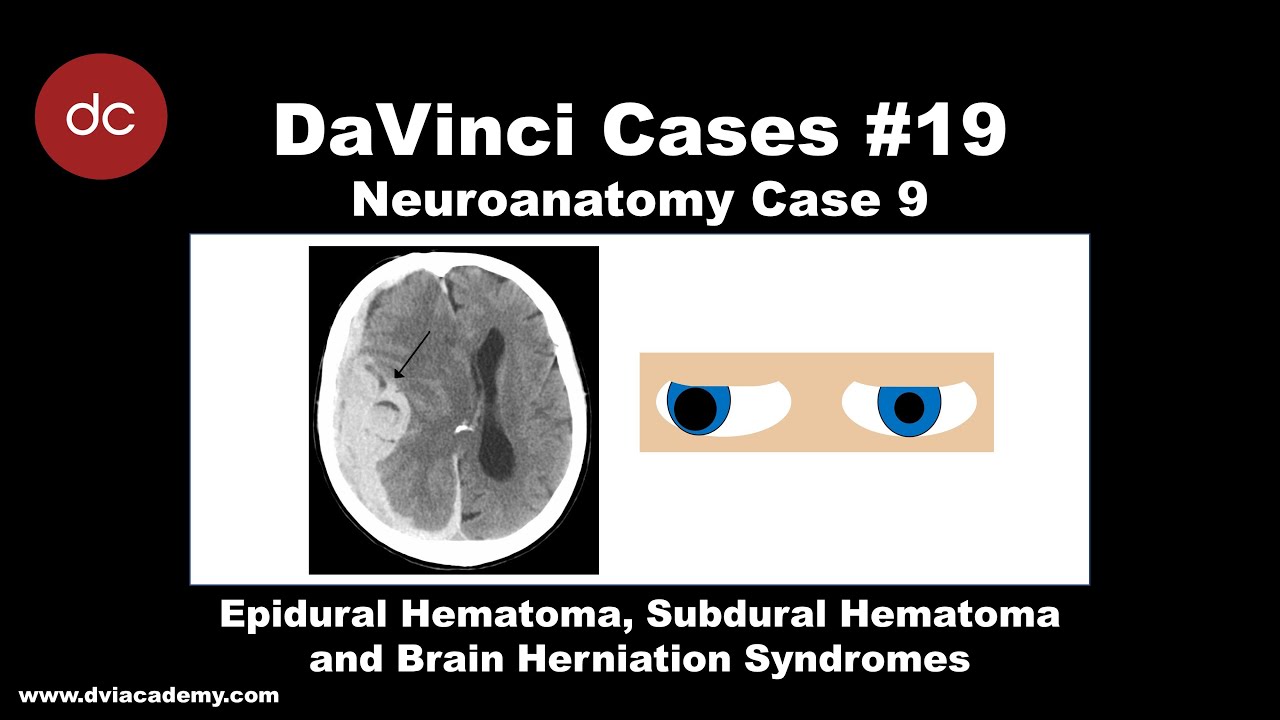 Epidural vs Subdural Hematoma and Brain Herniation Syndromes Case [# ...