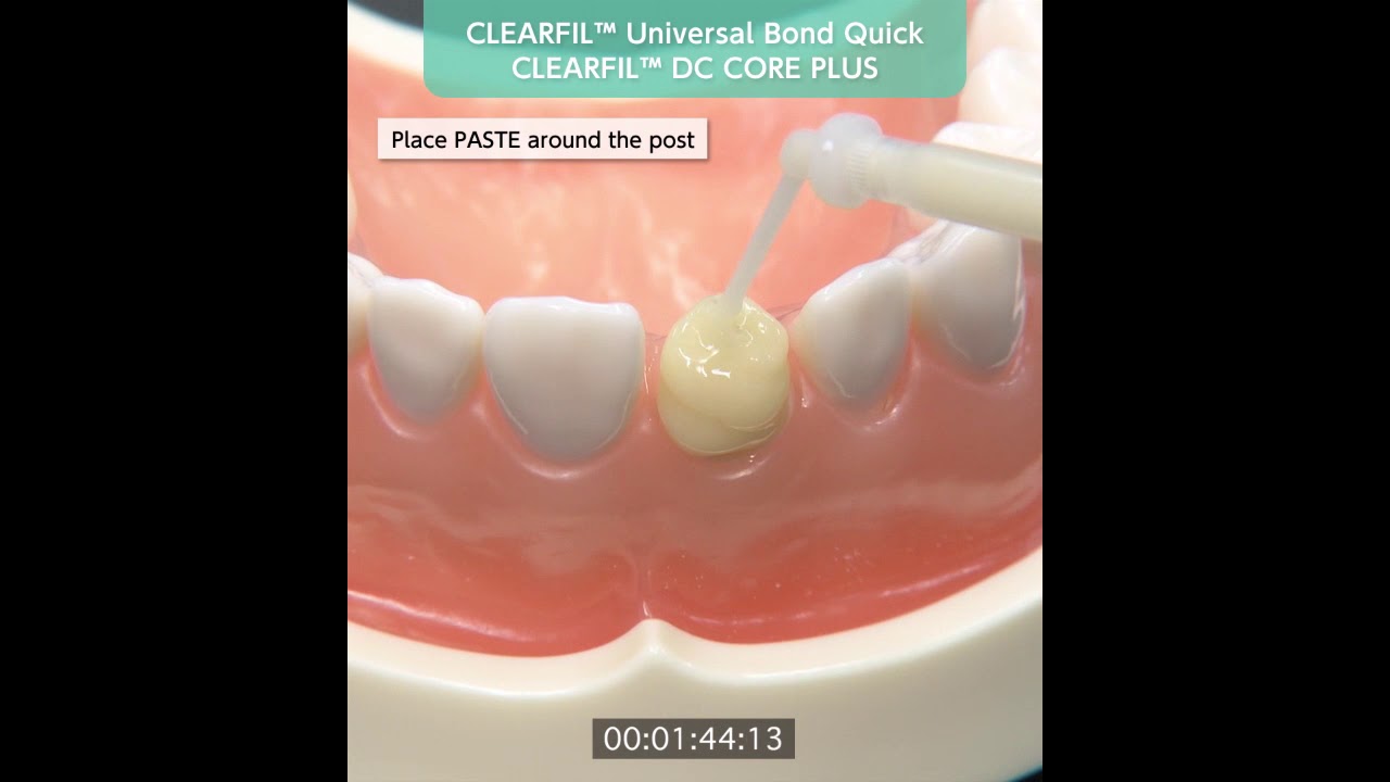 CLEARFIL DC CORE PLUS&QUICK KIT - YouTube