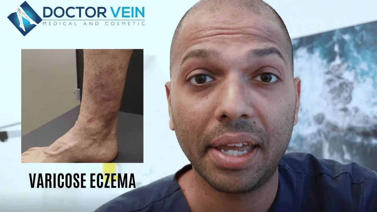 Varicose Eczema Itchy Rash near Varicose Veins - YouTube