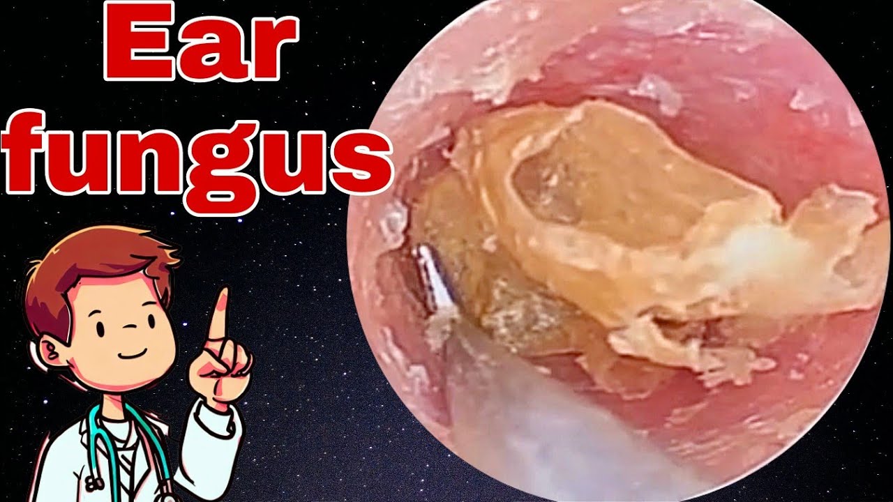 Ear wax and ear fungus removal - YouTube