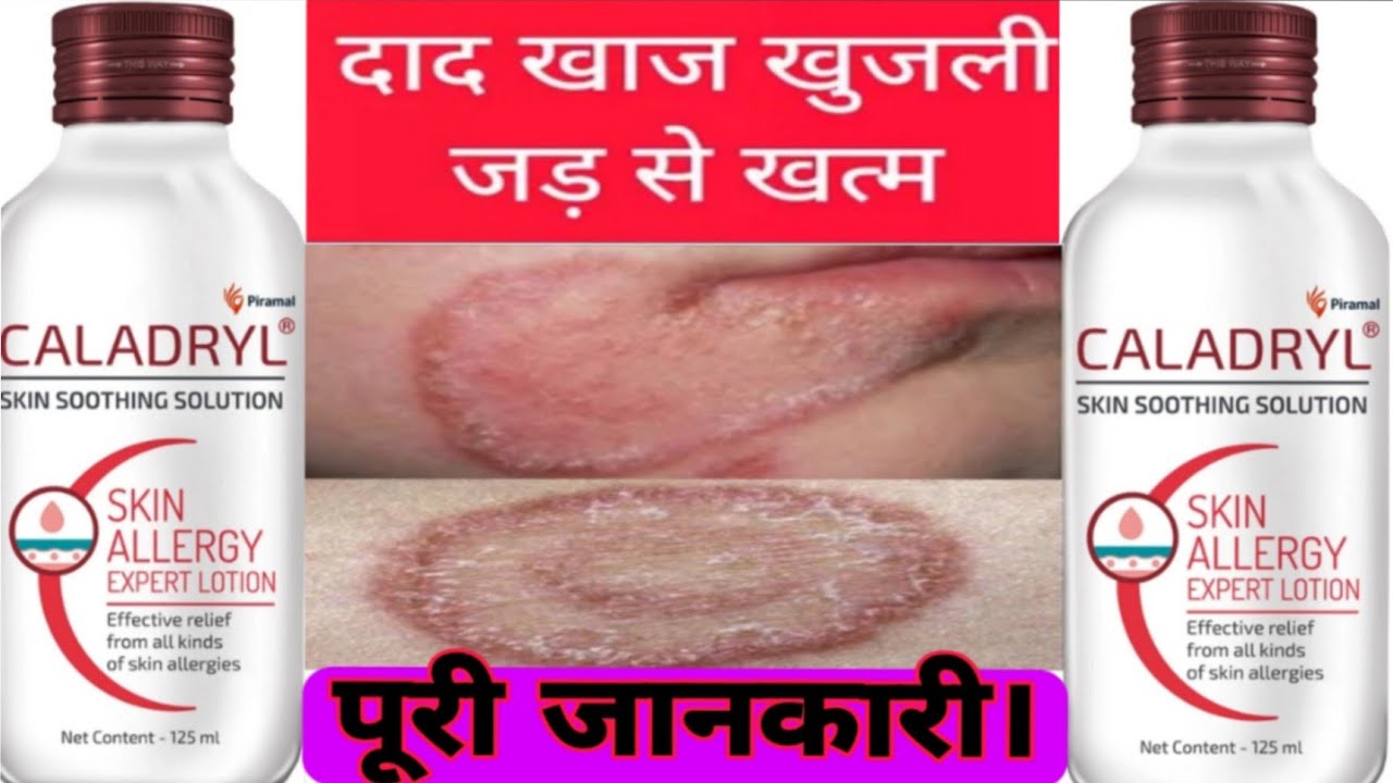 Use Of Caladryl Lotion Full Review in Hindi | How To Use Caladryl ...