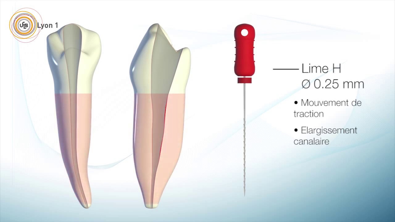 5- La lime H -Endodontie - YouTube