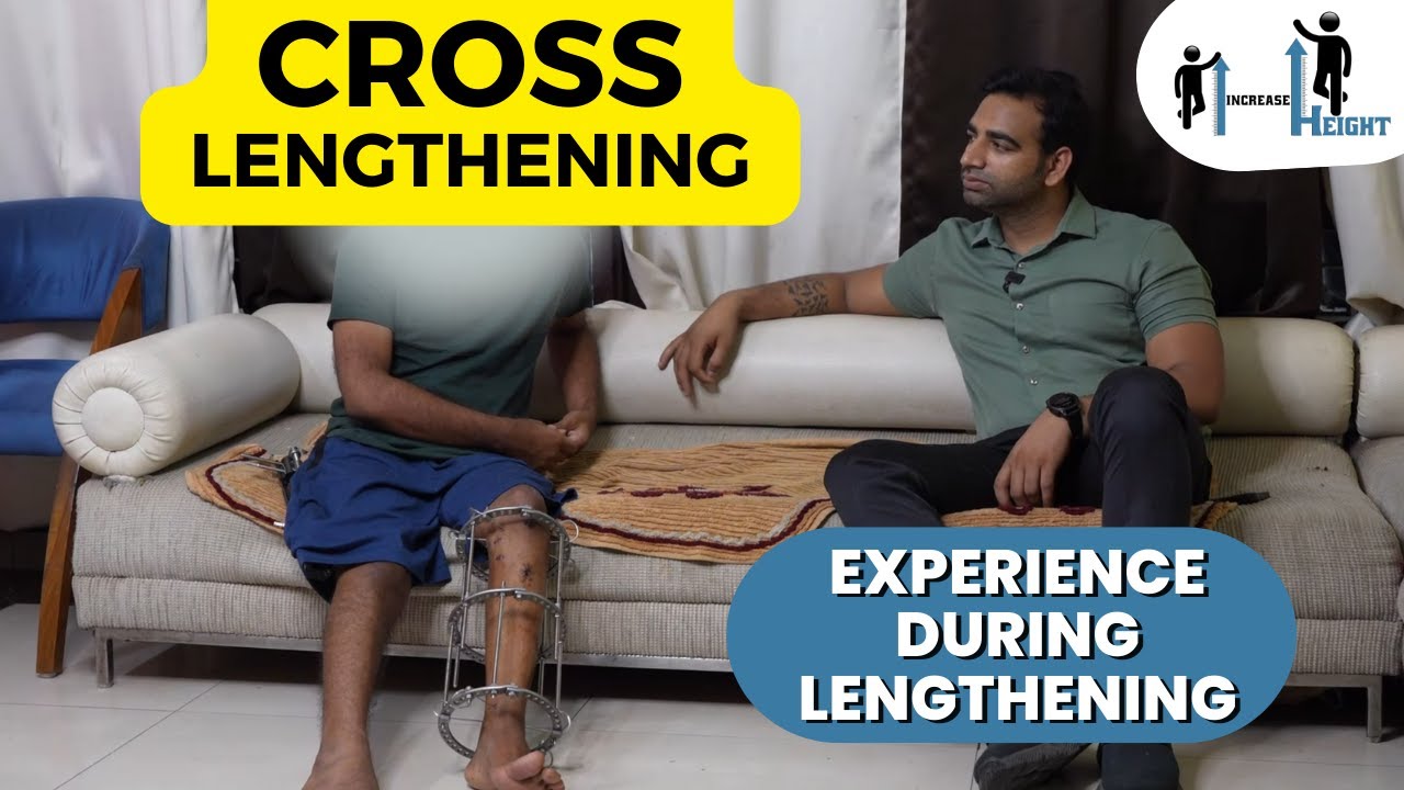 Cross Limb Lengthening Patient experience during Lengthening Phase with ...