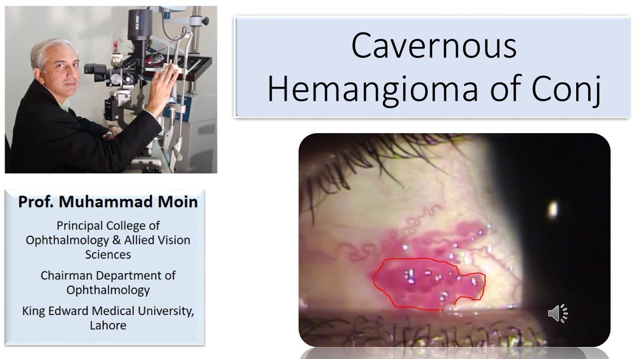 Cavernous Hemangioma of Conjunctiva - YouTube