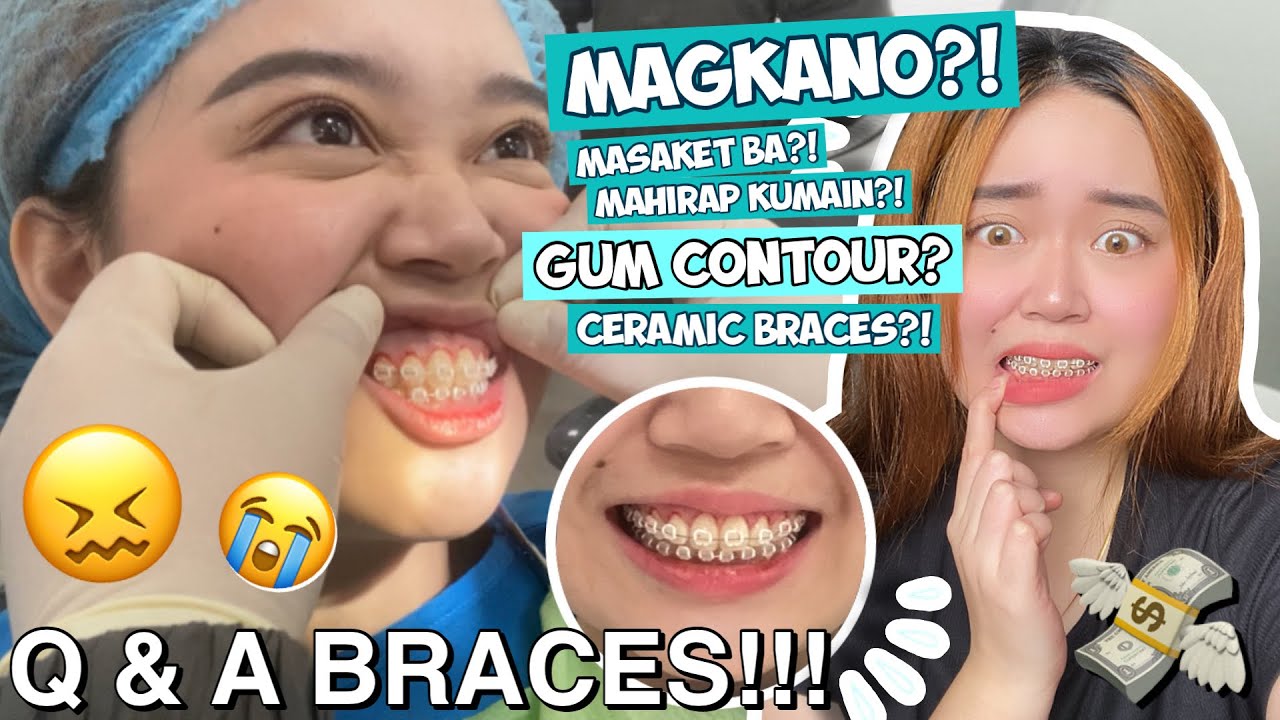 MAGKANO ANG BRACES KO? NAGPA GUM CONTOUR AKO? (Q&A ABOUT BRACES ...