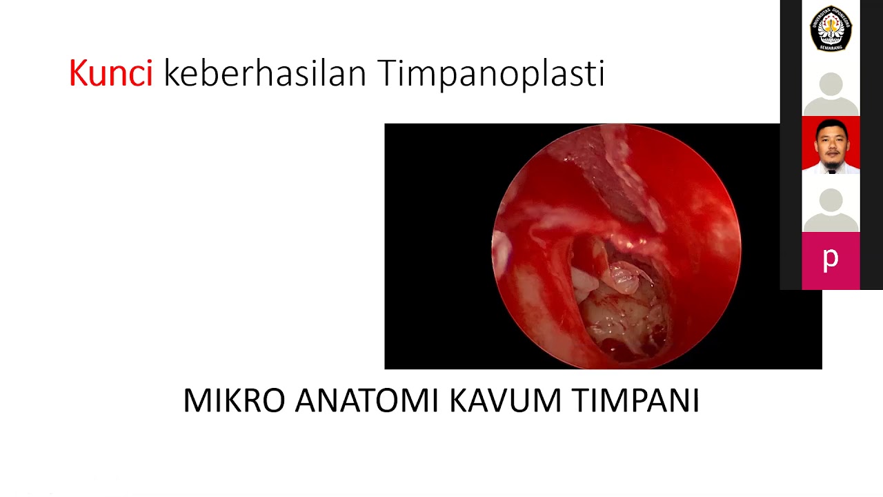 Faktor Keberhasilan Timpanoplasti - YouTube