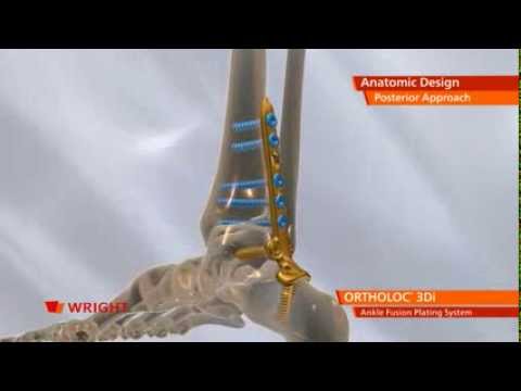 ORTHOLOC™ 3Di Ankle Fusion Plating System Animation - YouTube