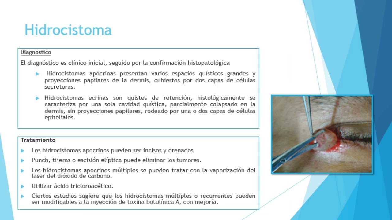 Hidrocistoma por Hugo Romo - YouTube